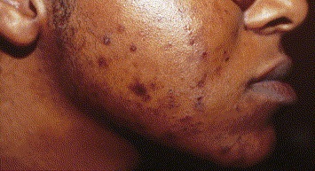 Comment se débarrasser de l’hyperpigmentation / taches sombres ...